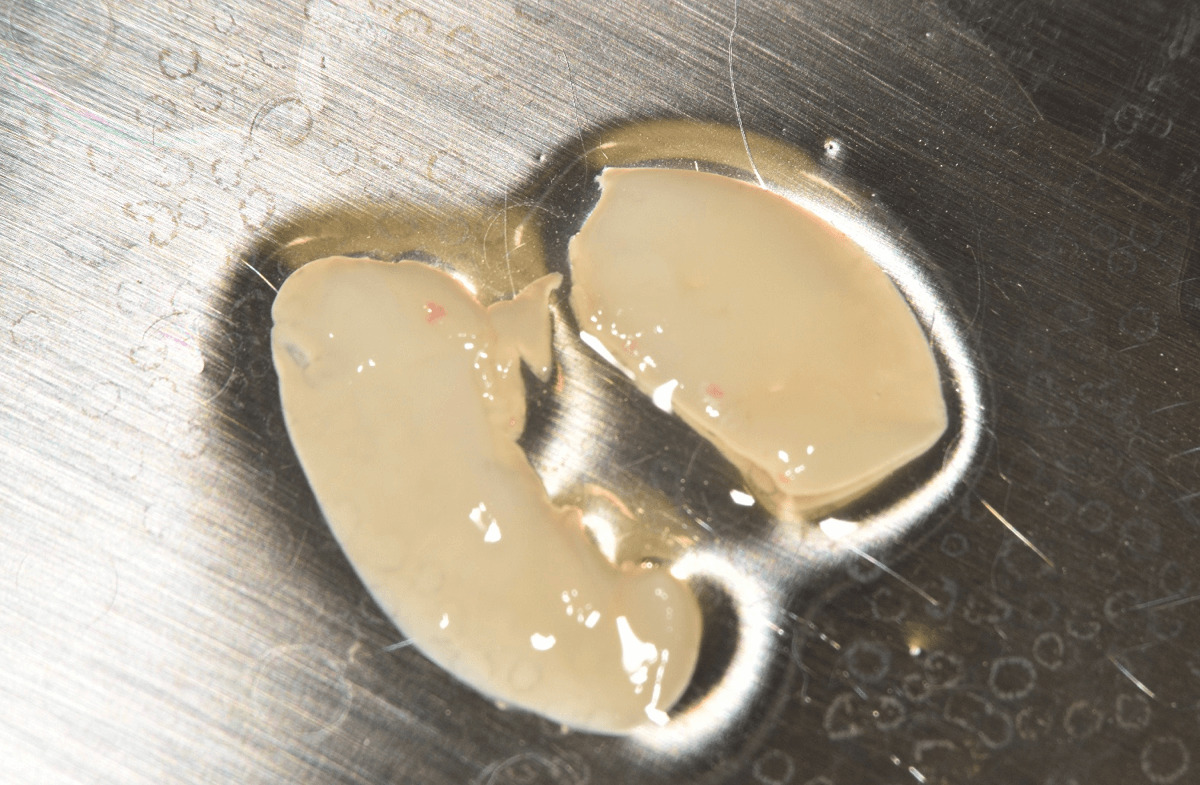 歯周組織再生療法 – CGFを用いて骨の少ない方でも安全にインプラントができる – 再生医療サーチコラム